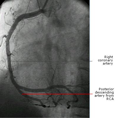 Posterior Descending Artery