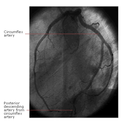 Posterior Descending Artery